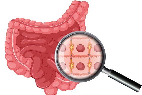 Comment prévenir la candidose à l'aide de la naturopathie? - Healthy Charly